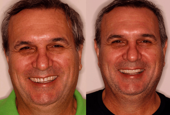 Sorriso Invertido - Clínica Renata Avighi - Piracicaba